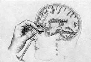 Lobotomy meme sound Meme Sound Effect - Voicy